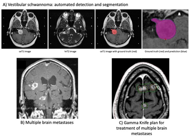 Automated tumour contouring of brain metastases for stereotactic radiosurgery planning and ...